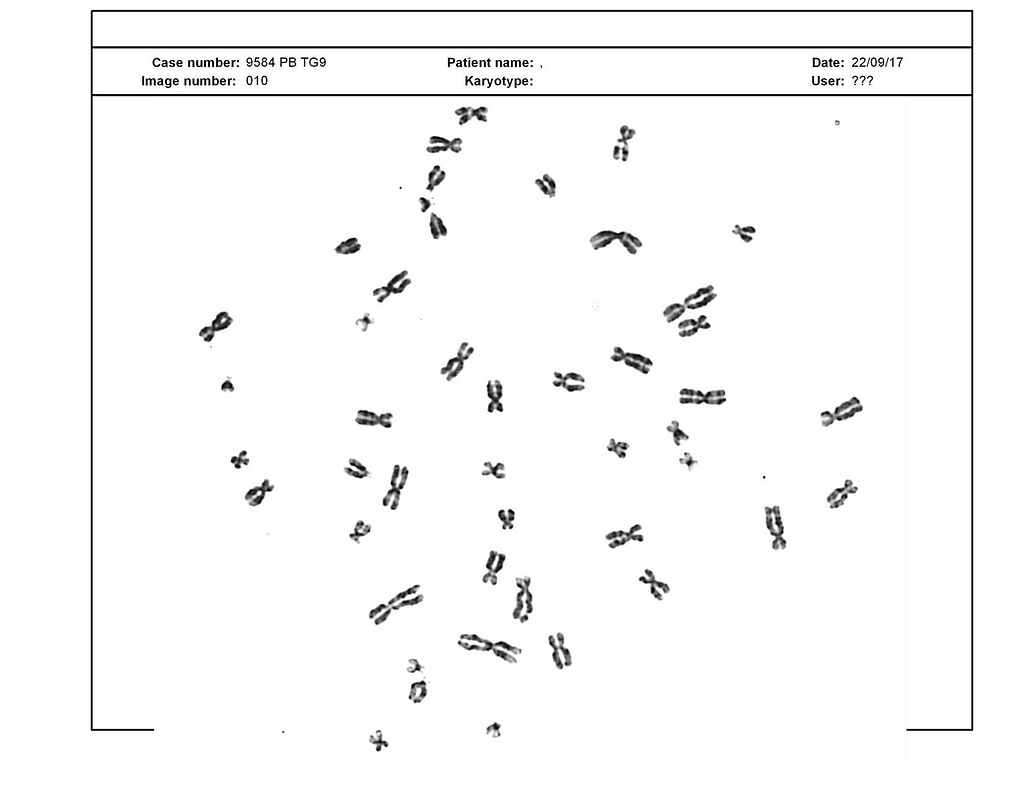 Examples of karyotyping – KaryotypingHub